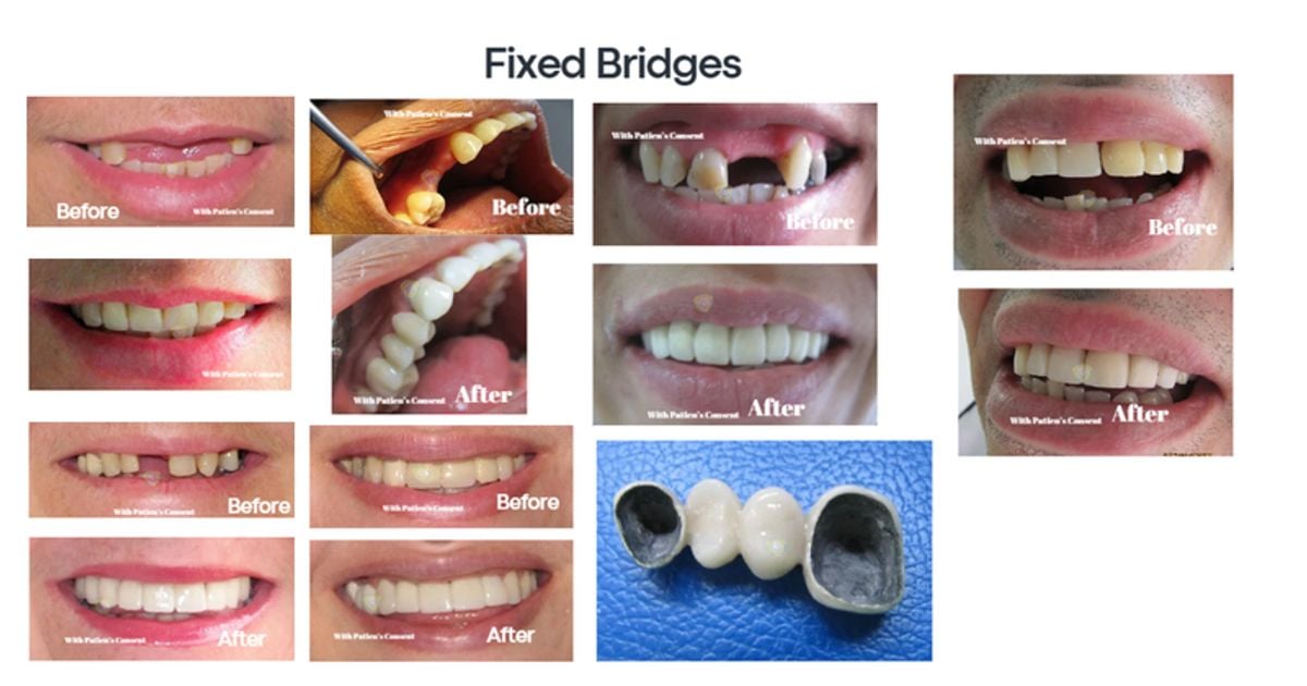 fixed-bridges